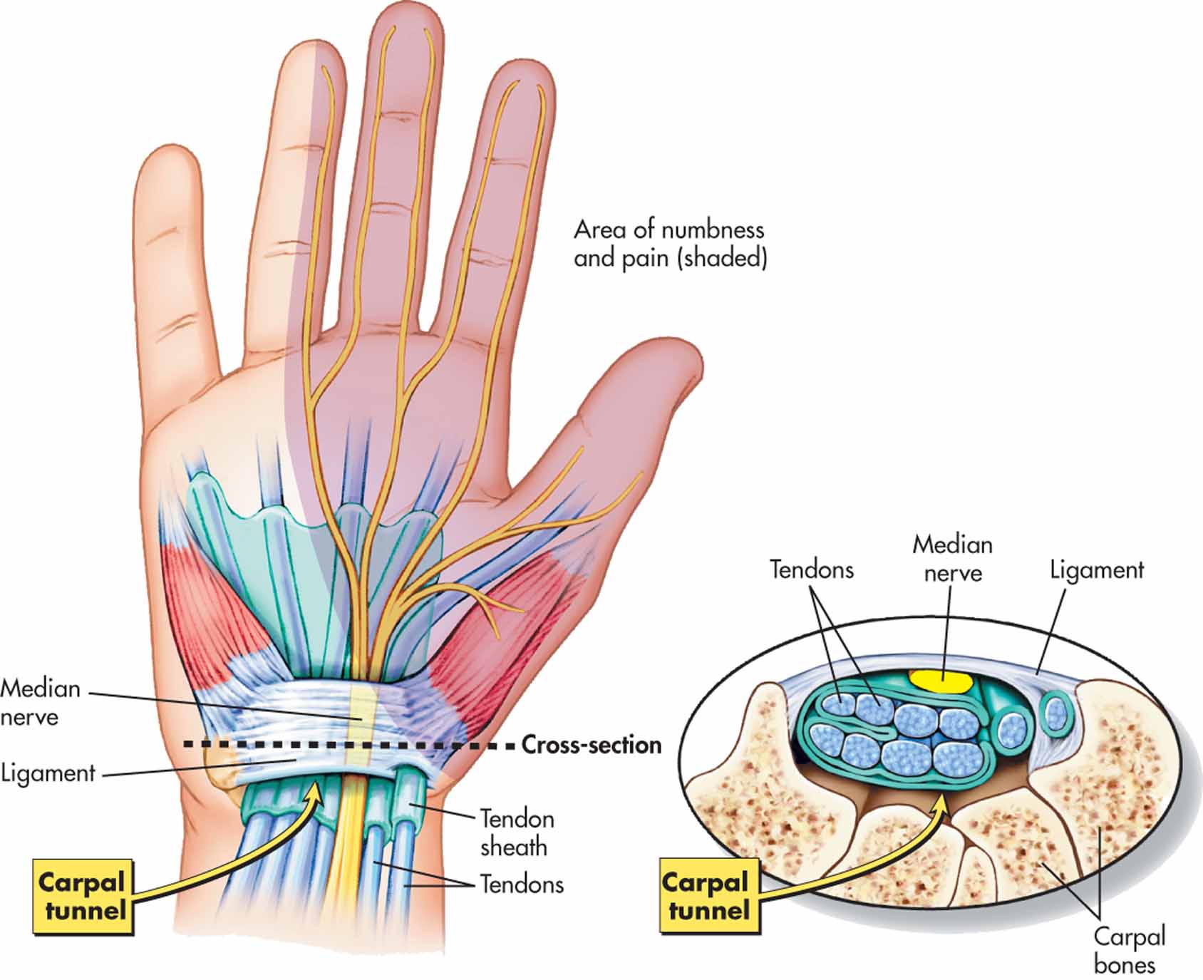 APA ITU CARPAL TUNNEL SYNDROME DAN RAWATANNYA