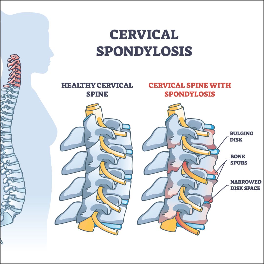 Gejala Cervical Spondylosis | Physiomobile