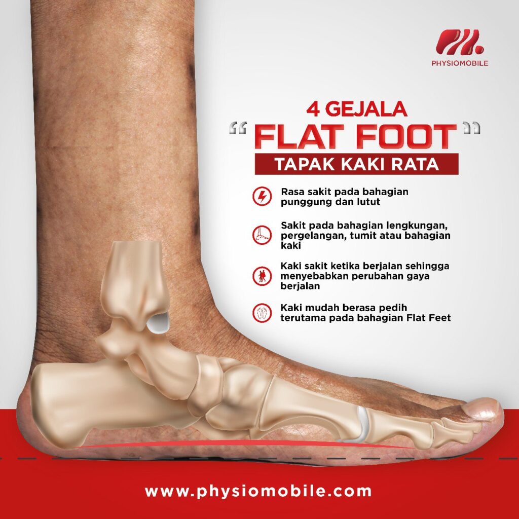 Tapak Kaki Rata (Flat Foot): 5 Senaman Untuk Anda Cuba
