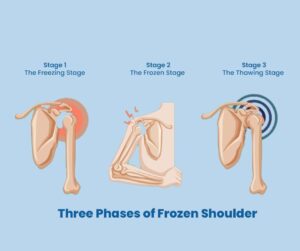 Frozen Shoulder Home Exercise You Should Try | Physiomobile