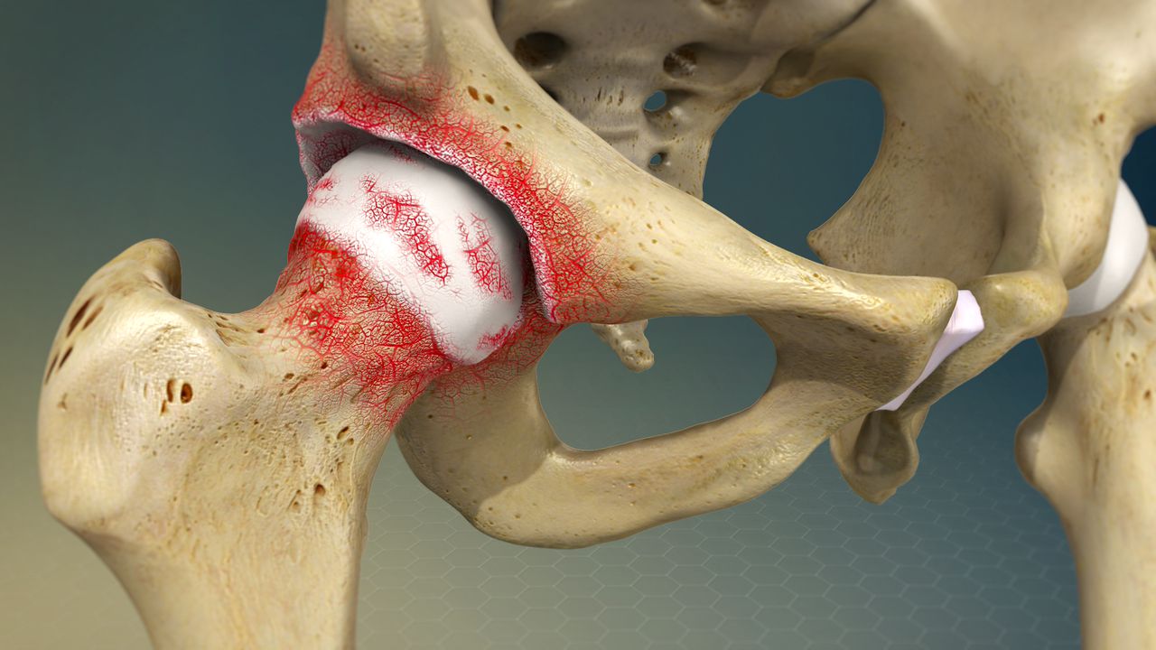 Sakit Pinggul Akibat Osteoarthritis? Jangan Biarkan Sampai Tak Boleh ...